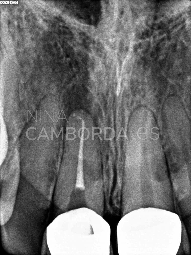 Conductos calcificados - Nina Camborda - Endodoncista