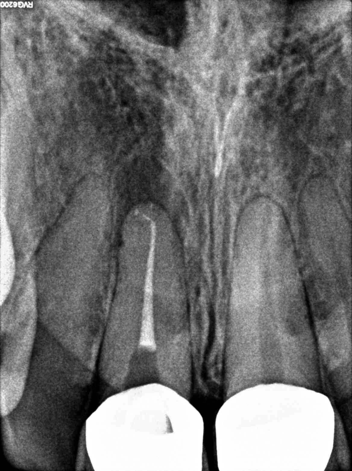 Conductos calcificados - Nina Camborda - Endodoncista