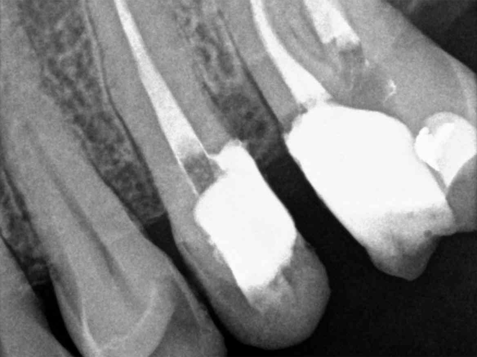 Deltas apicales - Nina Camborda - Endodoncista