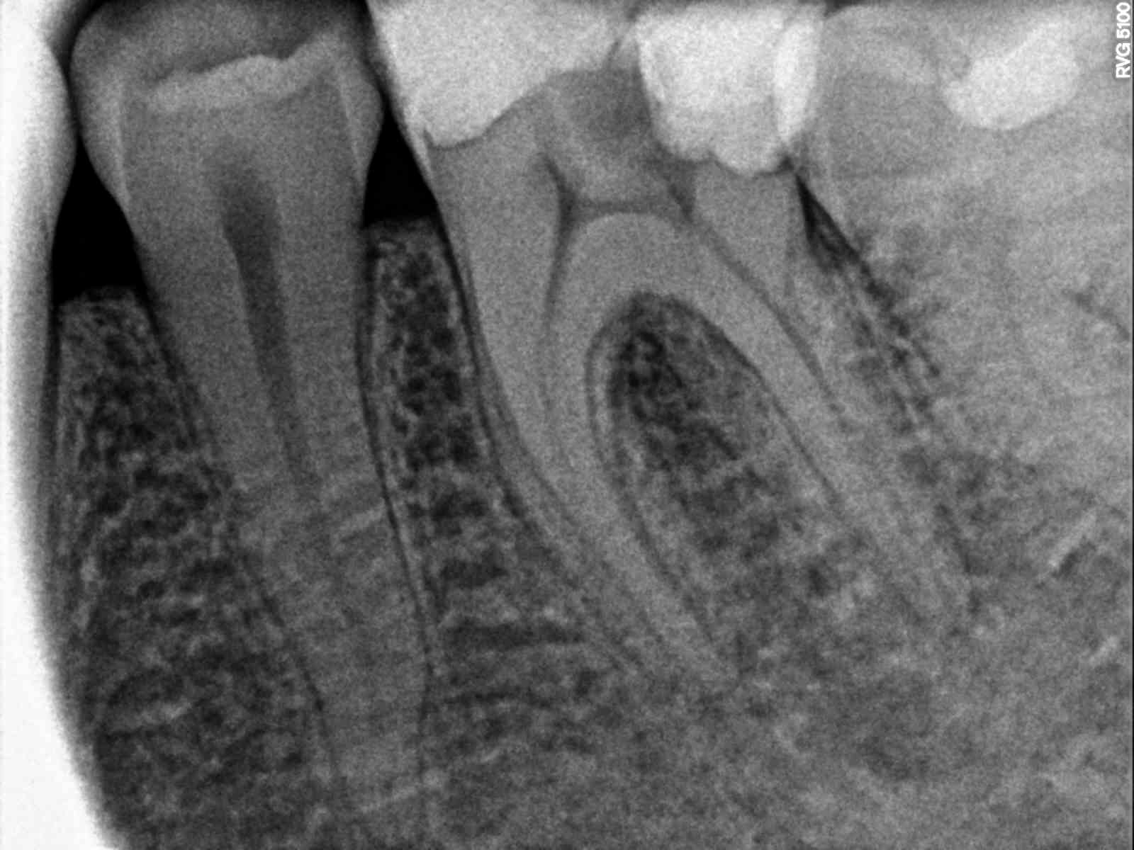Endodoncias de 5 conductos - Nina Camborda - Endodoncista