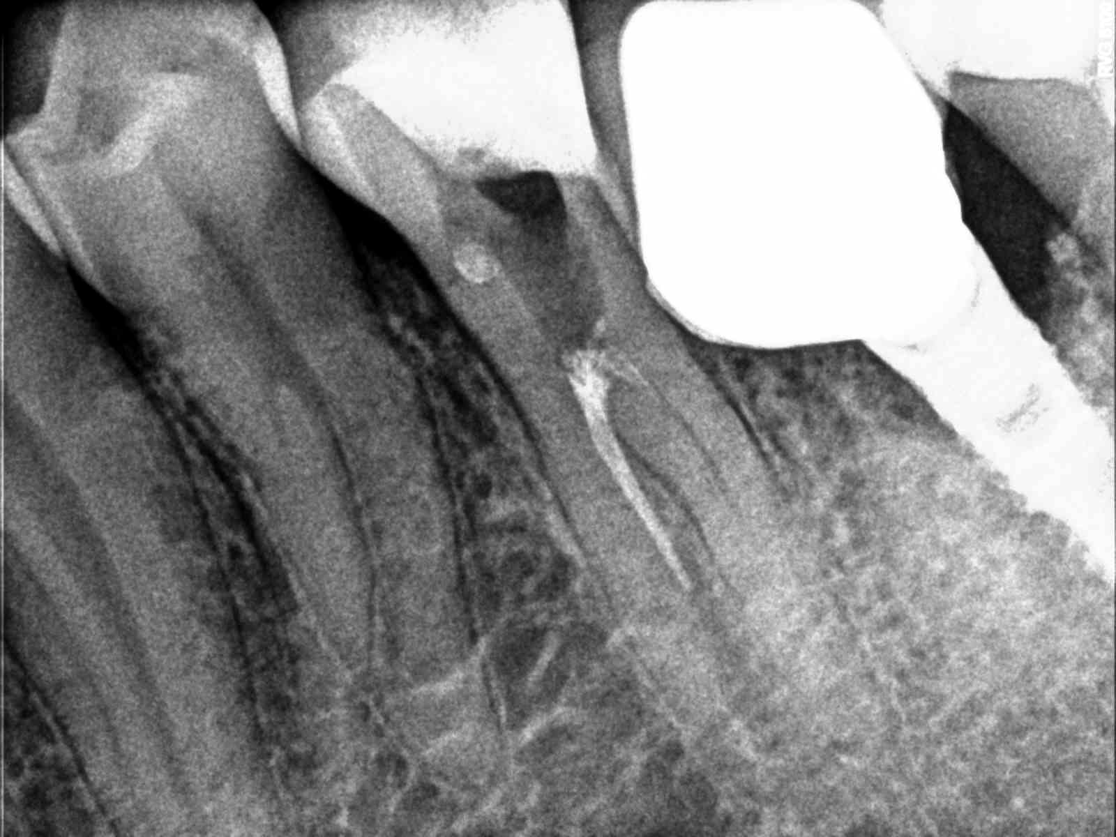 Premolares de 3 conductos - Nina Camborda - Endodoncista