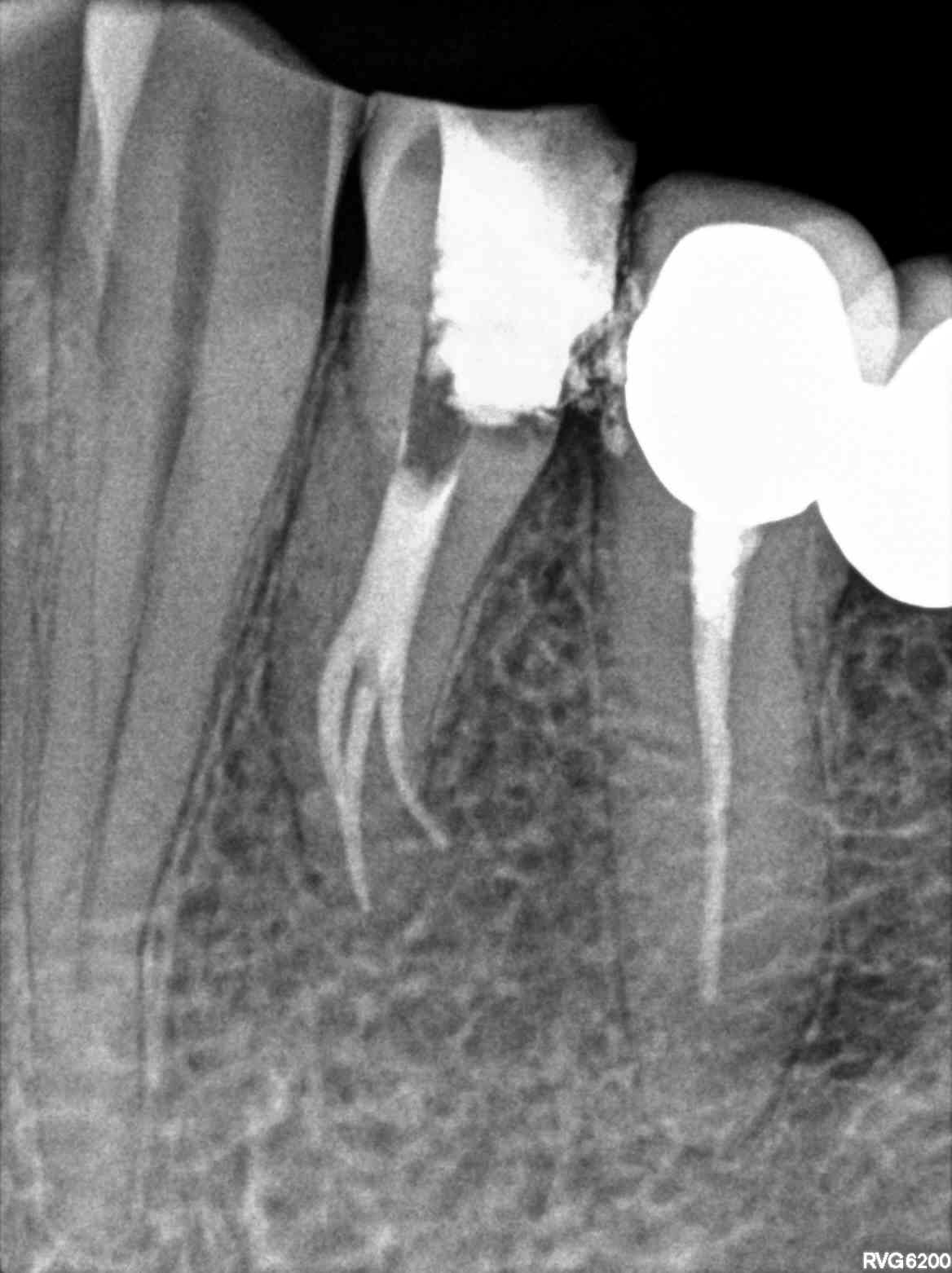 Premolares de 3 conductos - Nina Camborda - Endodoncista