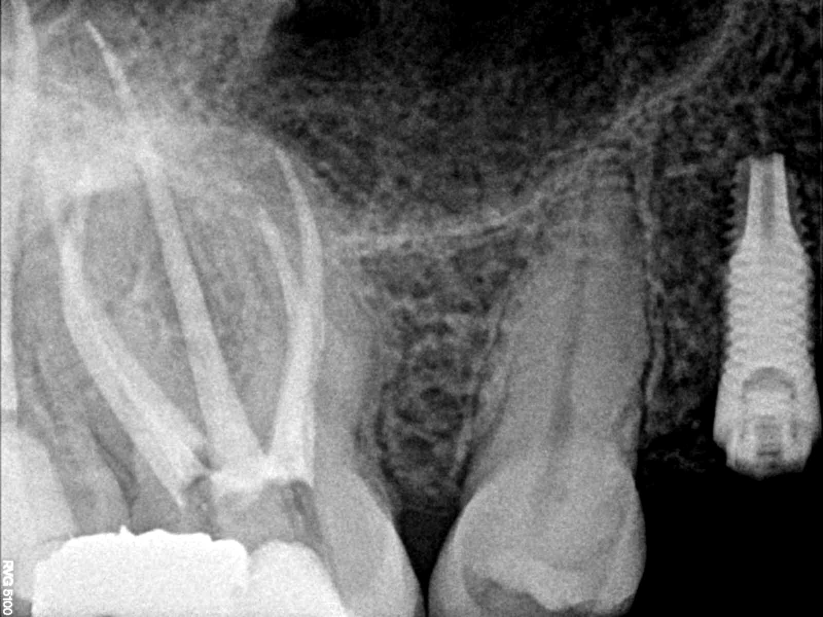 Endodoncias de 5 conductos - Nina Camborda - Endodoncista