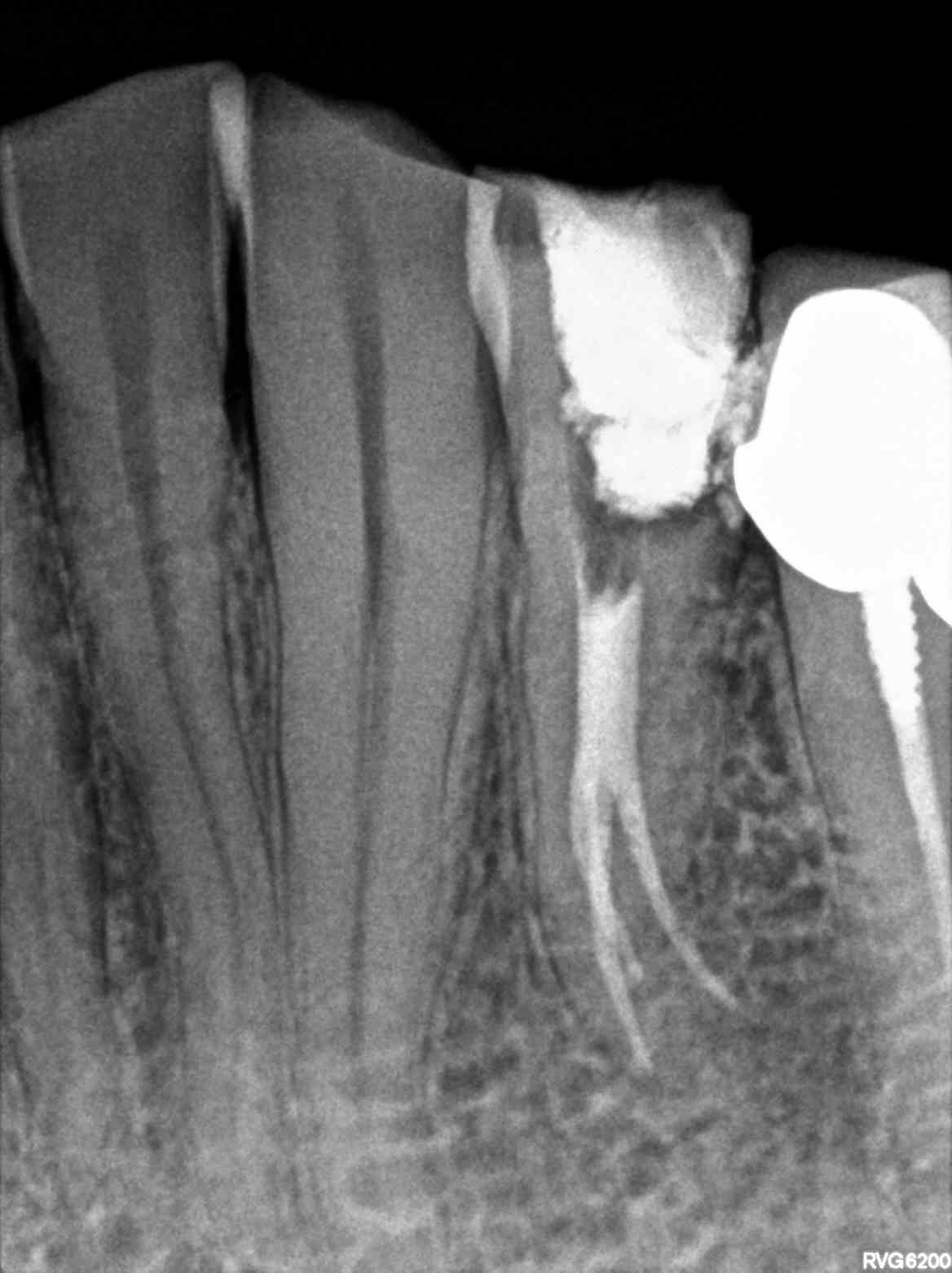Premolares de 3 conductos - Nina Camborda - Endodoncista