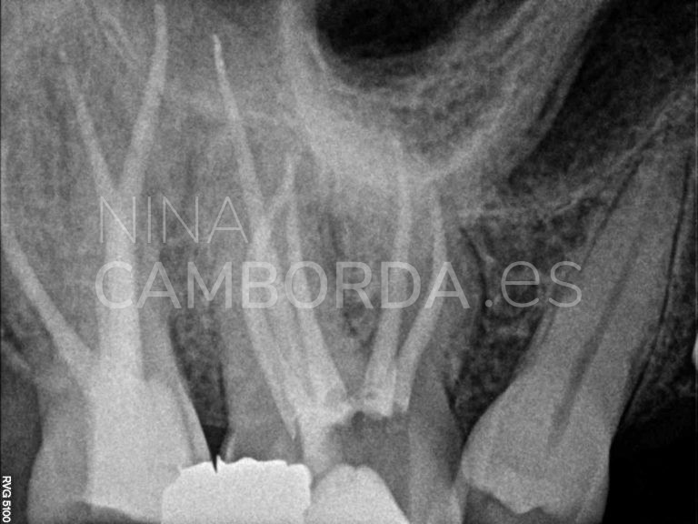 Endodoncias de 5 conductos - Nina Camborda - Endodoncista