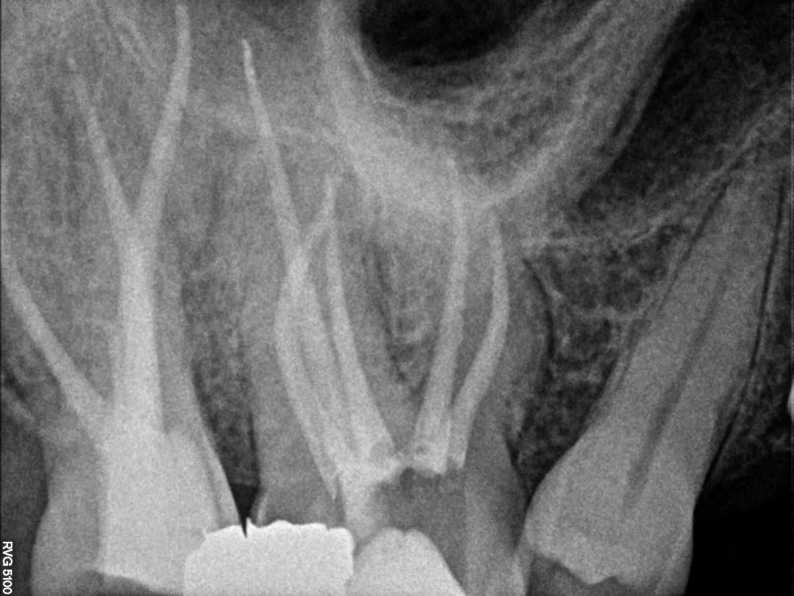 Endodoncias de 5 conductos - Nina Camborda - Endodoncista