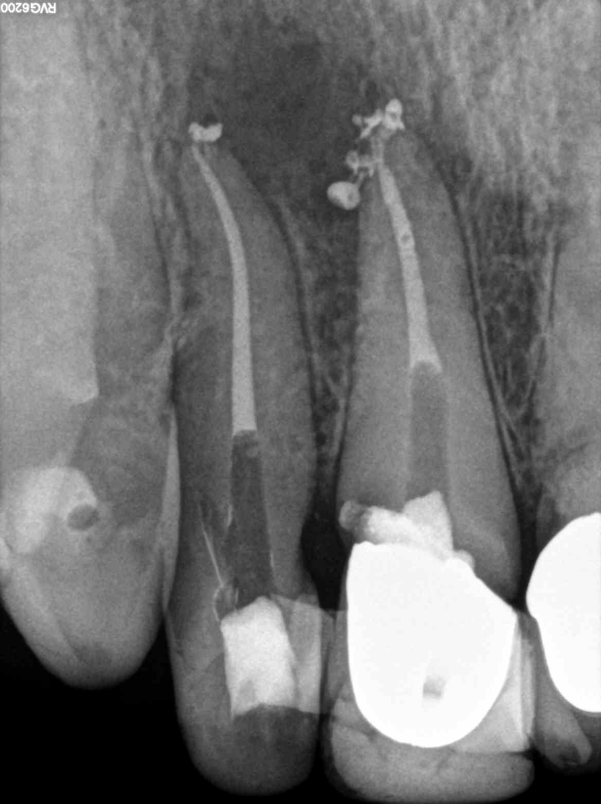 Conductos calcificados - Nina Camborda - Endodoncista