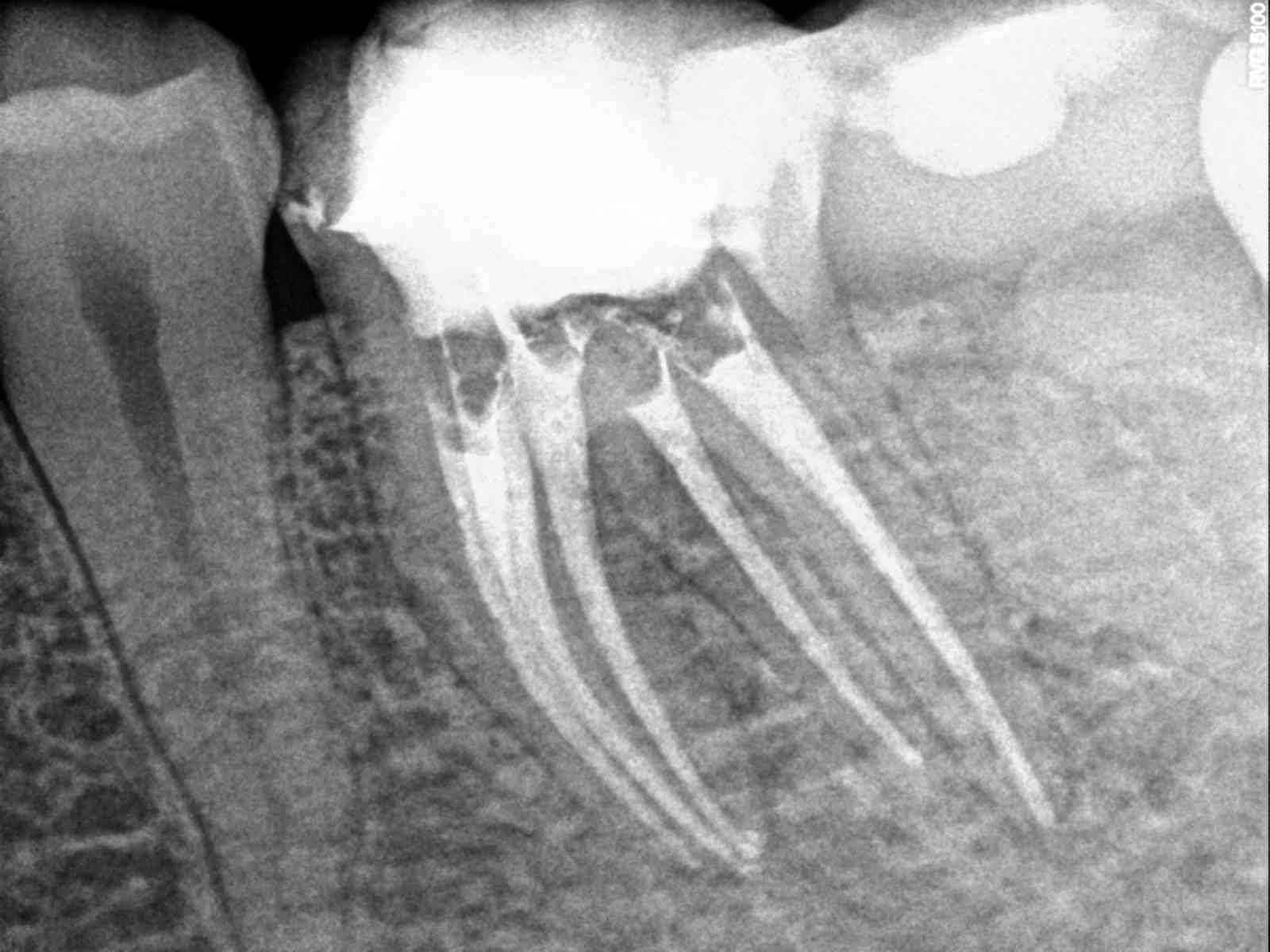 Endodoncias de 5 conductos - Nina Camborda - Endodoncista