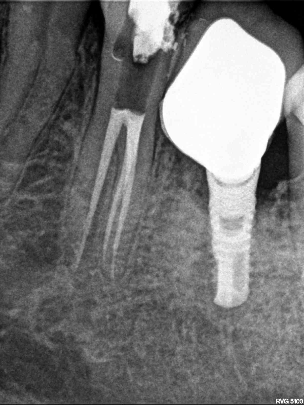 Premolares de 3 conductos - Nina Camborda - Endodoncista