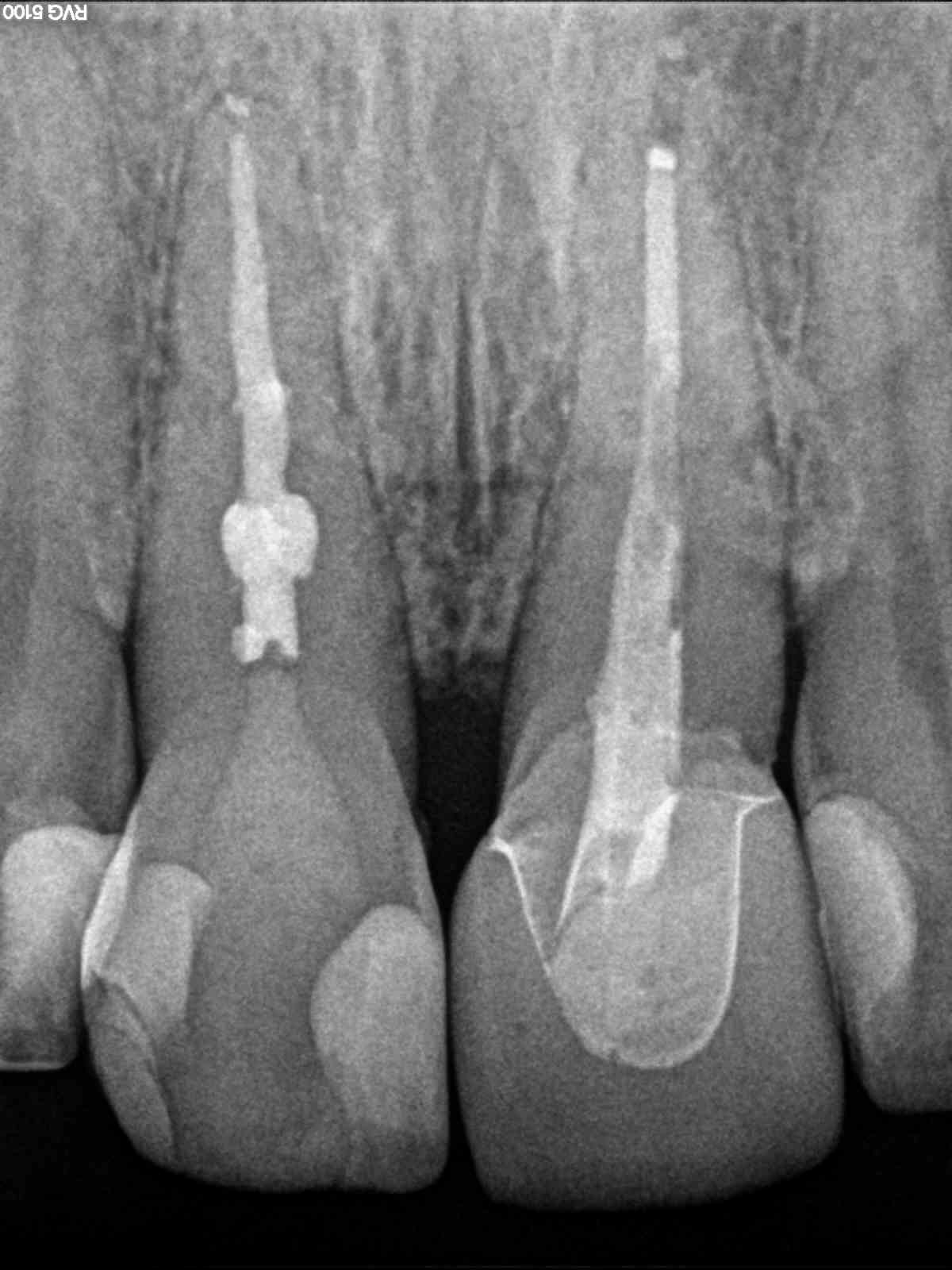 Reabsorciones radiculares - Nina Camborda - Endodoncista