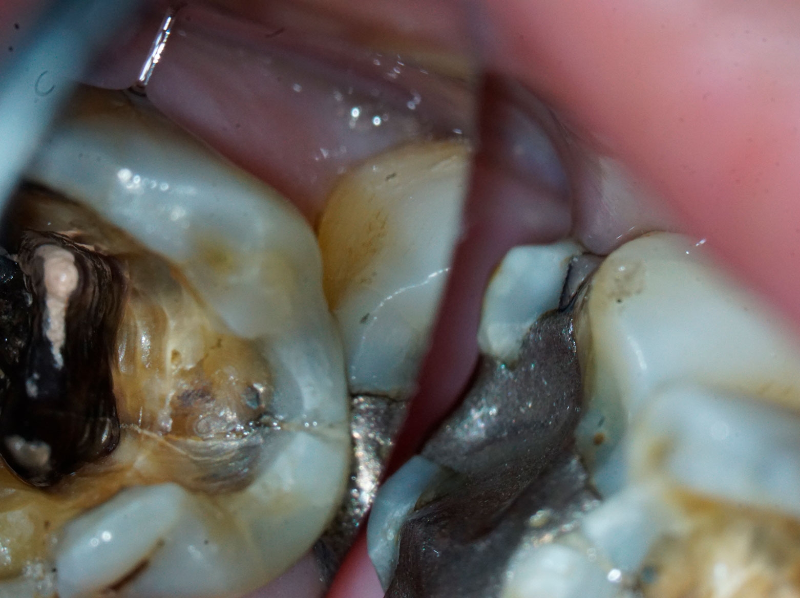 Diagnóstico de fisuras - Nina Camborda - Endodoncista